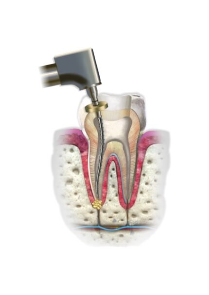 Endo Solution in Pakistan - EDTA Liquid for Root Canals Widening