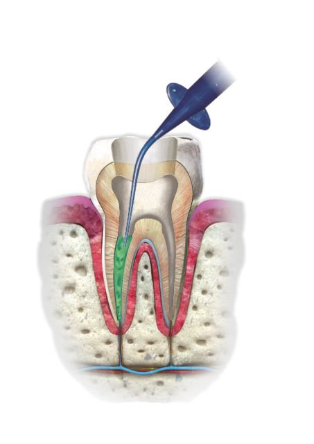 Endo Solution in Pakistan - EDTA Liquid for Root Canals Widening